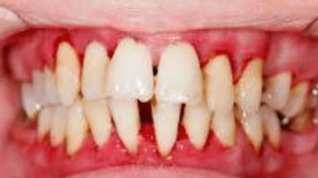 √ Penyakit Periodontal - Pengertian, Gambar & Macam-macamnya